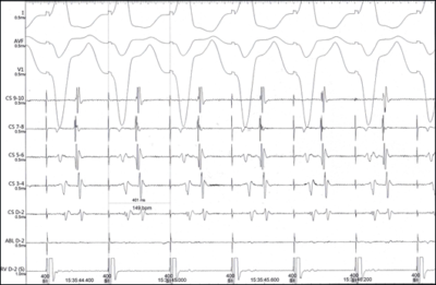 A Case of Wolf-Parkinson-White Syndrome with Atrial Fibrillation ...