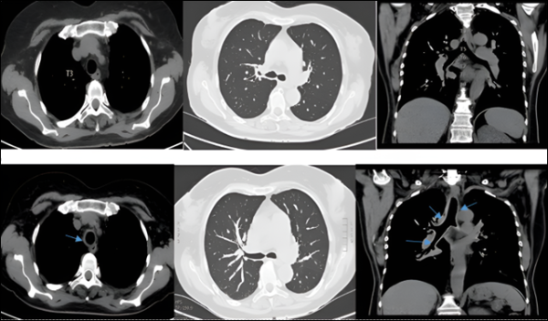 Ipilimumab Induced Tracheobronchitis - An Under-Recognized ...